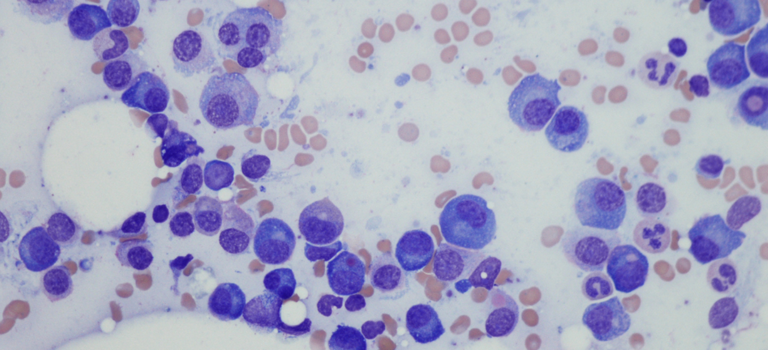 Bone Marrow vs. Cord Blood Stem Cell Transplant | Americord Registry