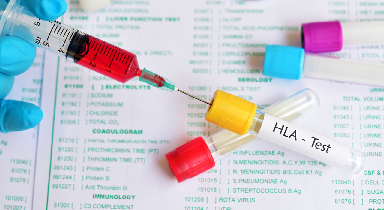 Human Leukocyte Antigen (HLA) Matching And Stem… | Americord Registry